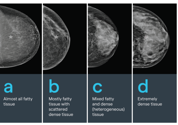 Dense Breast Tissue | Kettering Health